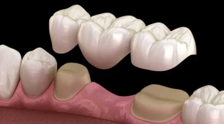Types of Dental Restorations - BlueSmartMia
